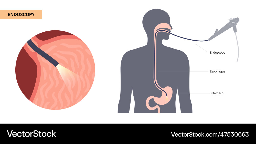 Gastroscopy Procedure – Endoscopy Royalty Free Vector