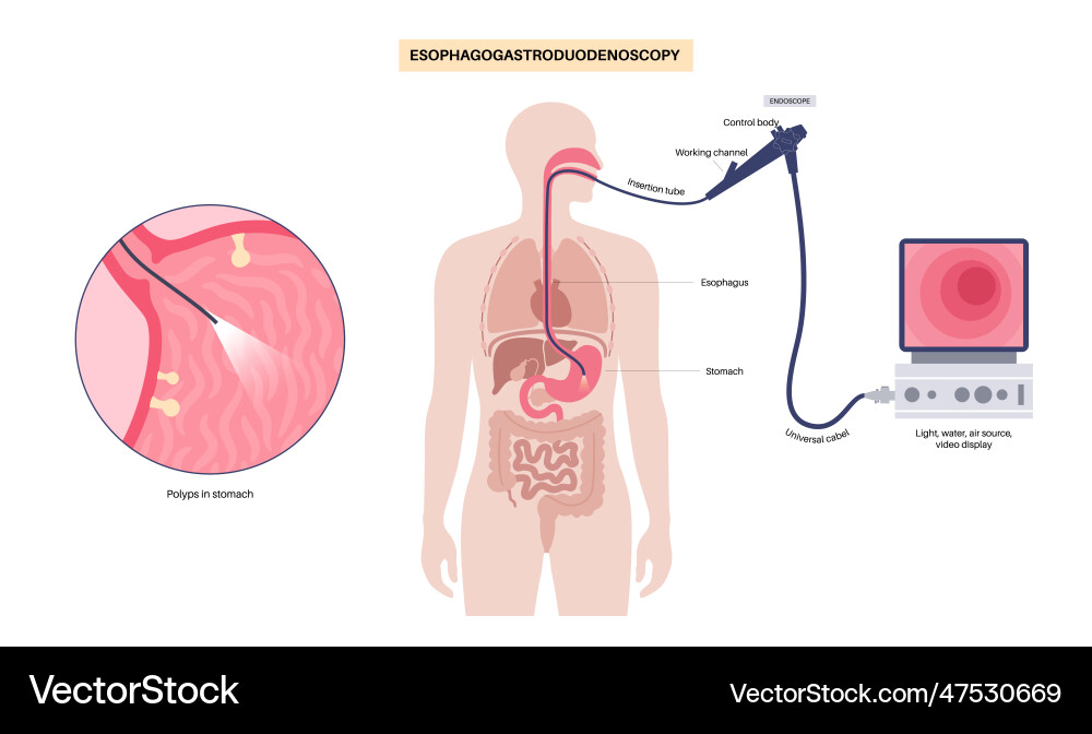 Gastroscopy Procedure – Polyp Diagnosis Vector Image