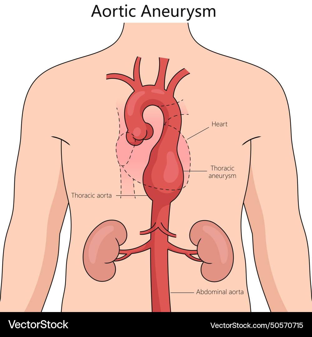 Aortic aneurysm structure diagram medical science Vector Image