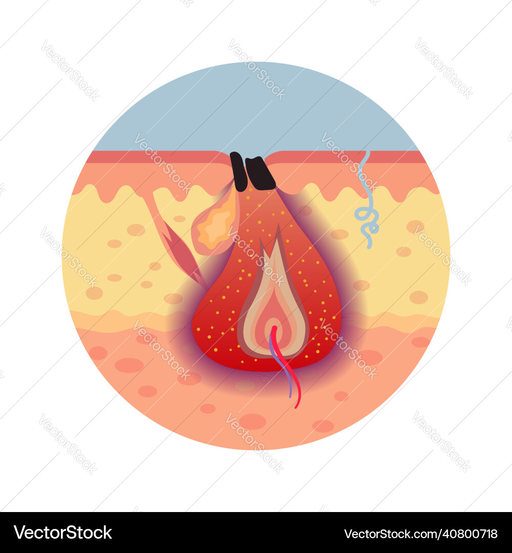 Propionibacterium Acnes 320+ Propionibacterium Acnes Stockfoto's,