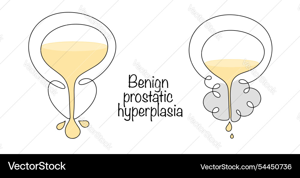 Prostatische Hyperplasie Lizenzfreies Vektorbild