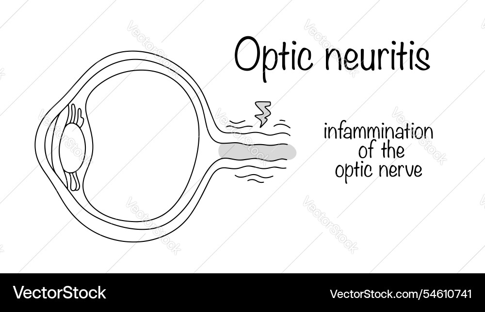 Optic neuritis Royalty Free Vector Image - VectorStock