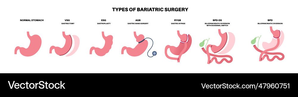 Bariatric surgery poster Royalty Free Vector Image