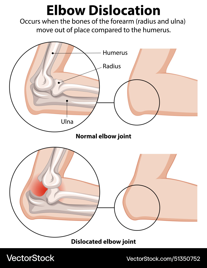 Comparison of normal and dislocated elbow joints Vector Image