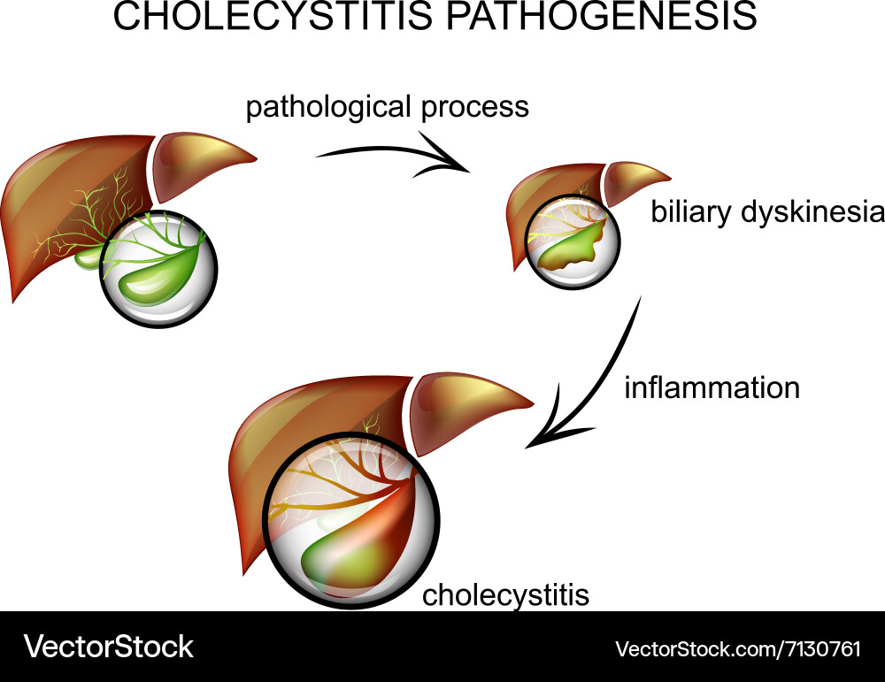 Cholecystitis pathogenesis Royalty Free Vector Image