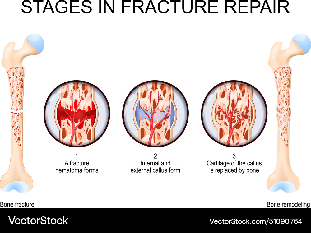 Stages in fracture repair from bone Royalty Free Vector