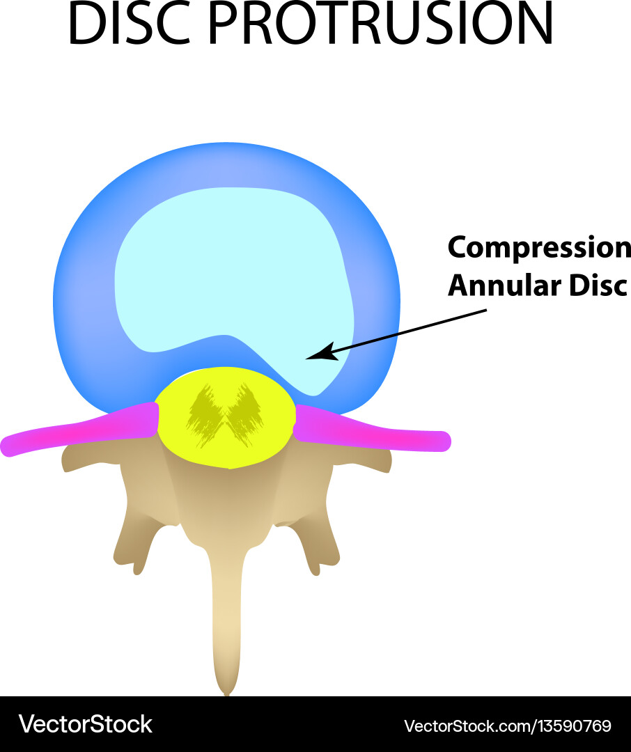 Disc Protrusion - Spinal Anatomy Royalty Free Vector Image