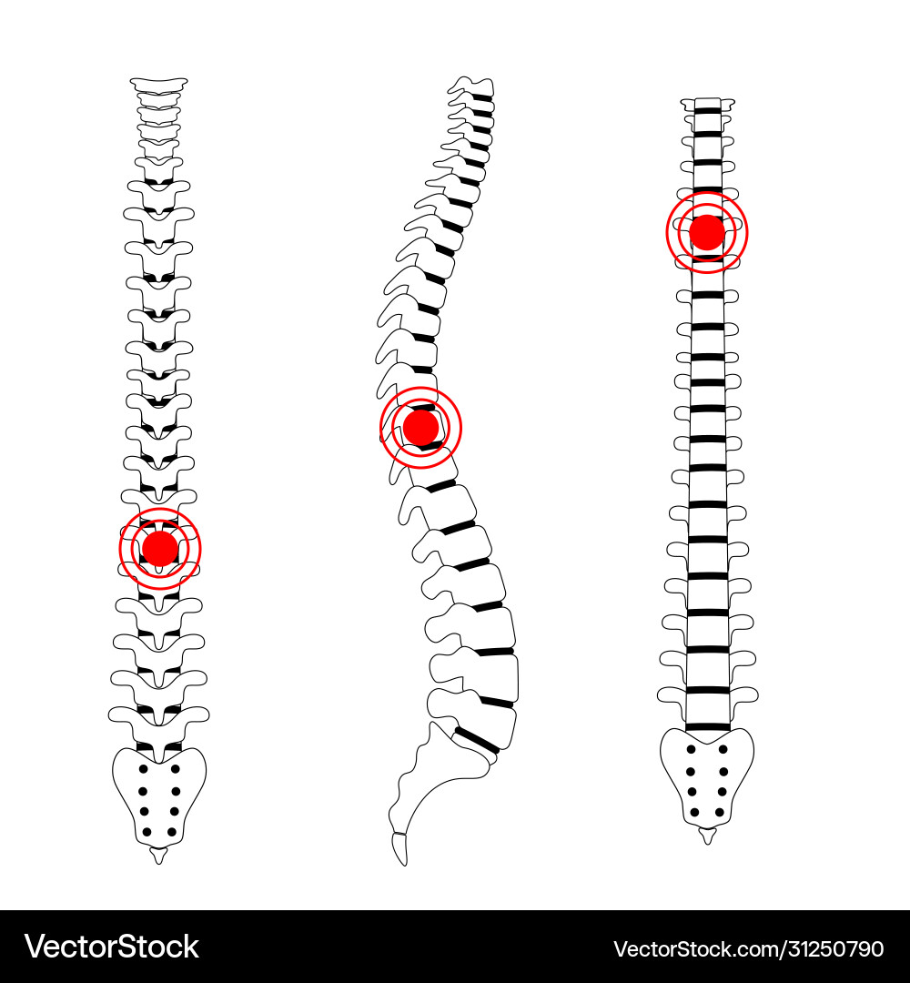 Human spine pain Royalty Free Vector Image - VectorStock