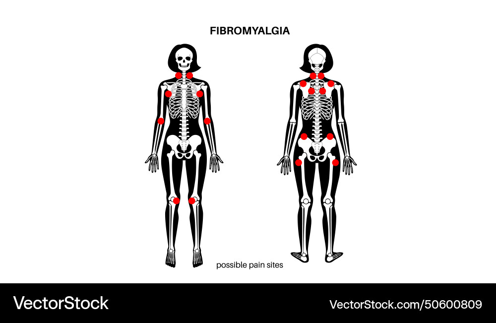 Fibromyalgia medical poster Royalty Free Vector Image