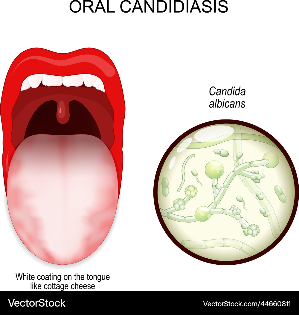 Oral candidiasis thrush yeast infection Royalty Free Vector