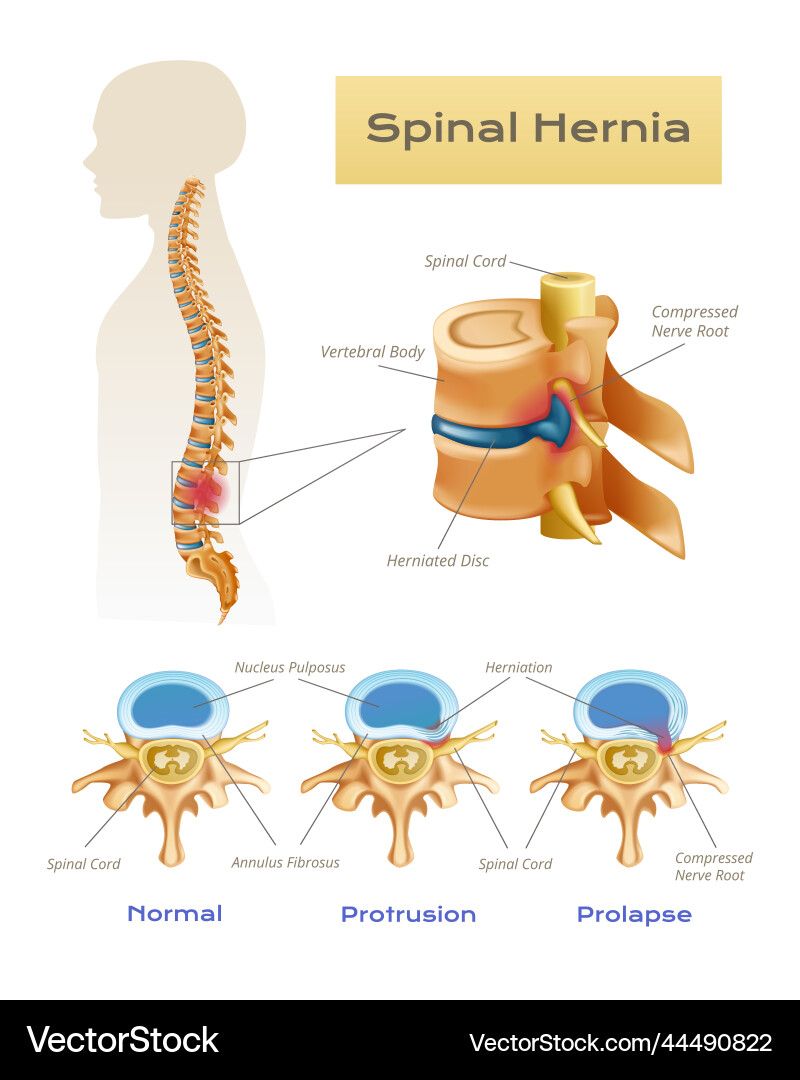 Anatomy spinal hernia infographics Royalty Free Vector Image Anatomy spinal hernia infographics Royalty Free Vector Image