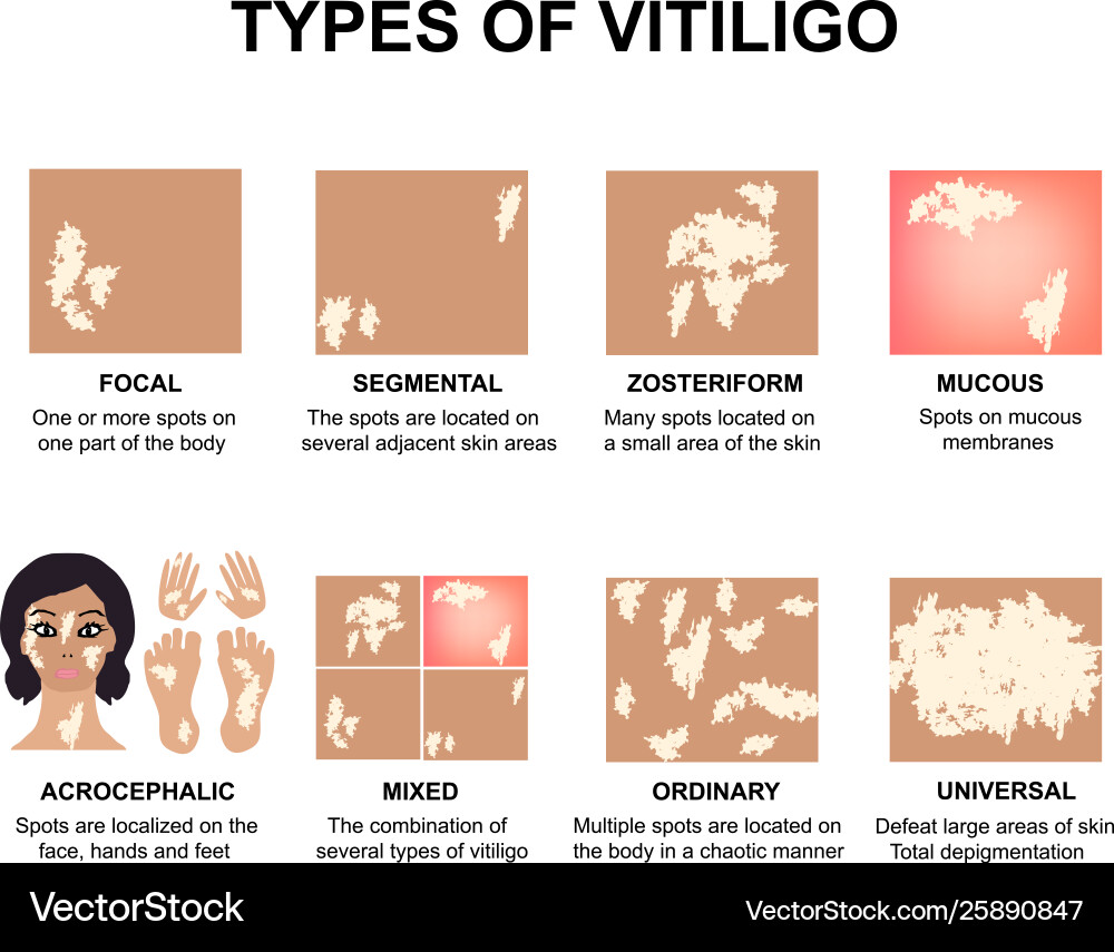 Types vitiligo world day Royalty Free Vector Image