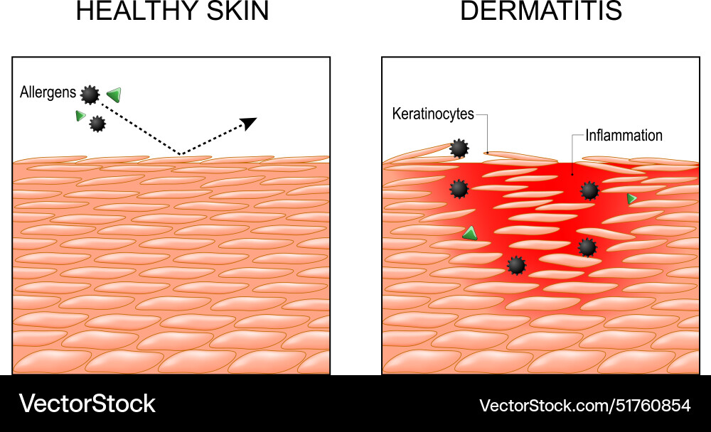 Dermatitis eczema psoriasis cross section Vector Image