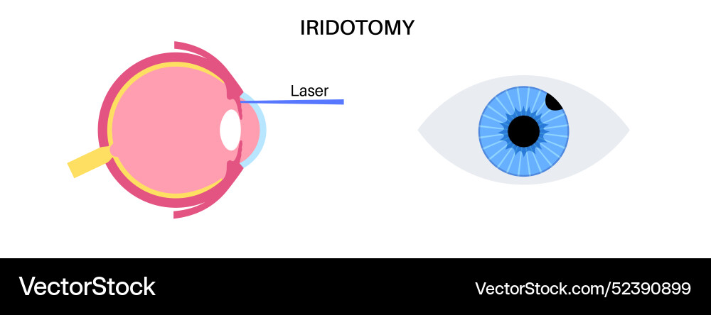 Iridectomy medical poster Royalty Free Vector Image