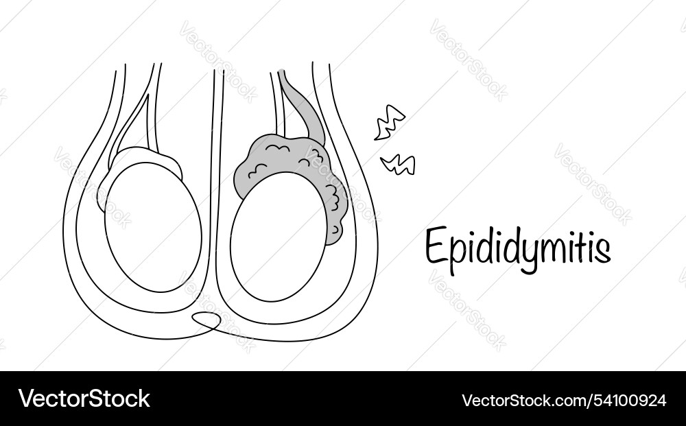 Epididymitis - Anatomy & Inflammation Vector Image