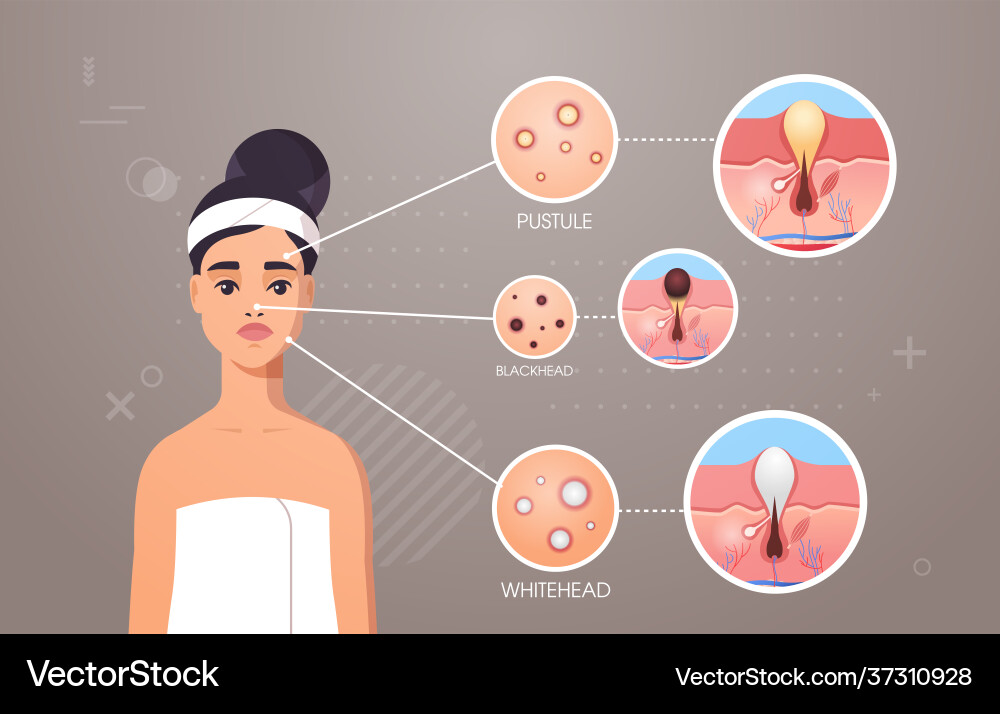 Different types facial skin acne pustule Vector Image