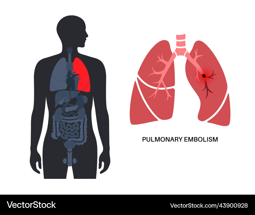 Pulmonale Embolism Anatomie Lizenzfreies Vektorbild
