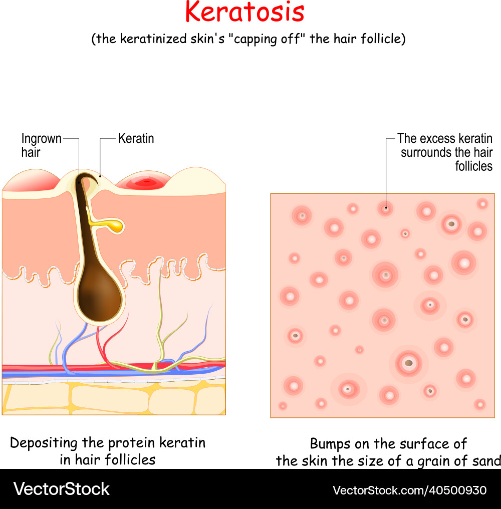 Keratosis skin disease Royalty Free Vector Image