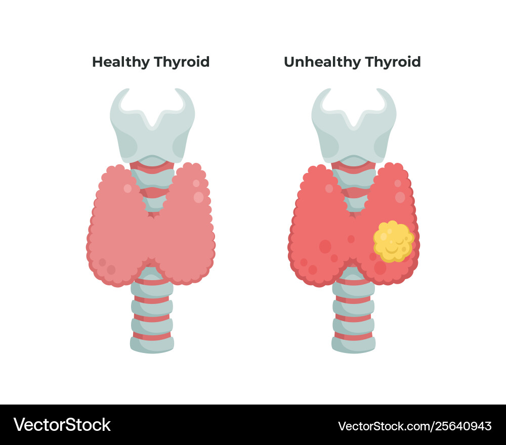 Healthy thyroid gland and unhealthy Royalty Free Vector