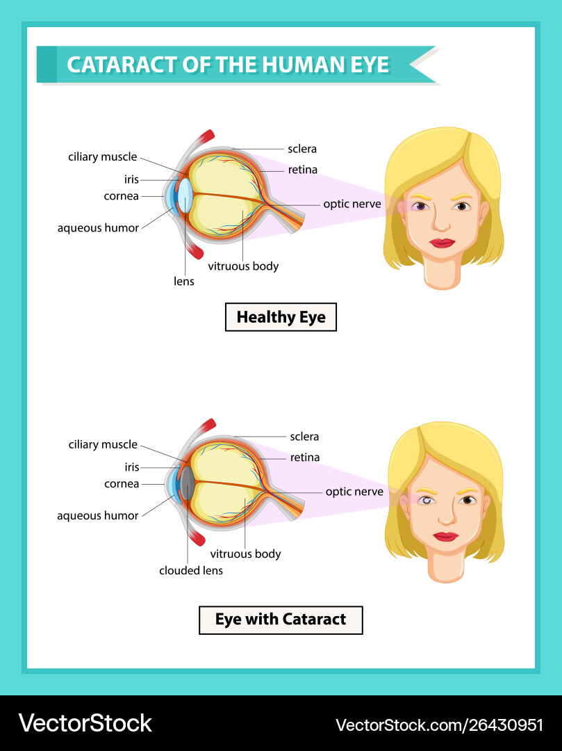 Scientific medical cataract human eye Royalty Free Vector