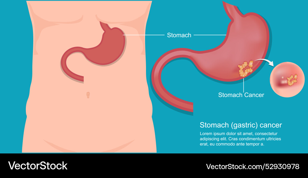 Stomach gastric cancer Royalty Free Vector Image