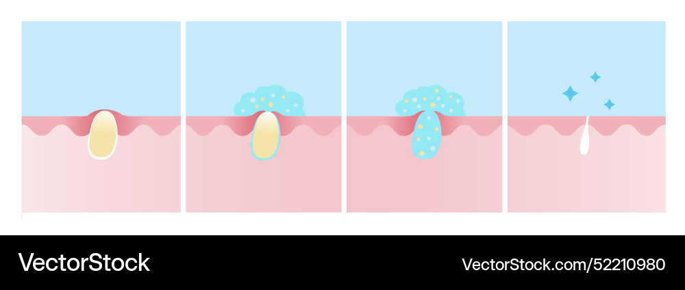 Step of acne pimple treatment process Royalty Free Vector