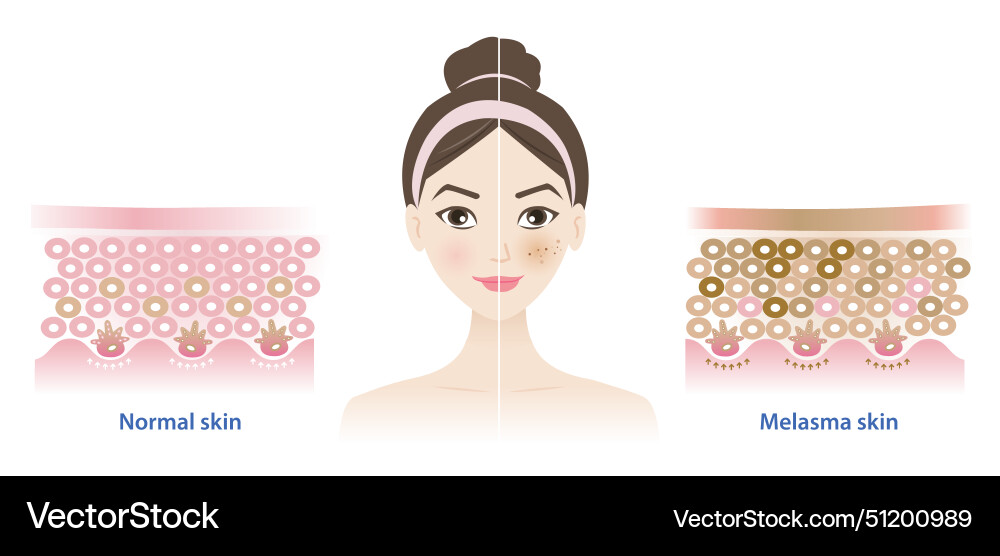 Comparison of normal and melasma skin Royalty Free Vector