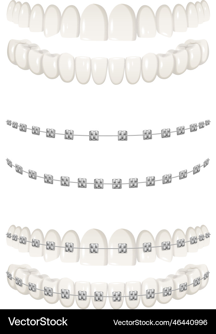 Teeth braces set Royalty Free Vector Image - VectorStock