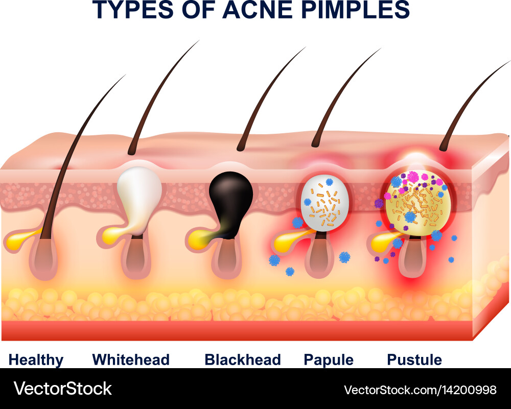Skin Anatomy: Acne Types & Features Royalty Free Vector