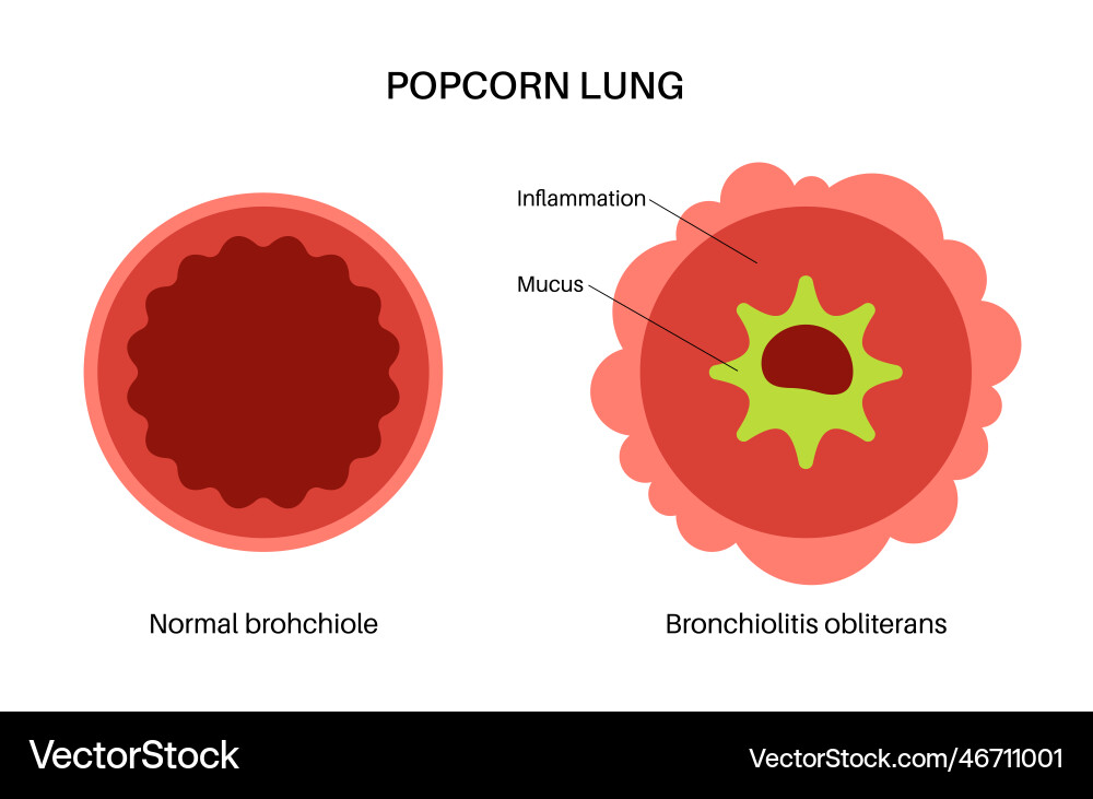 Popcorn lung disease Royalty Free Vector Image