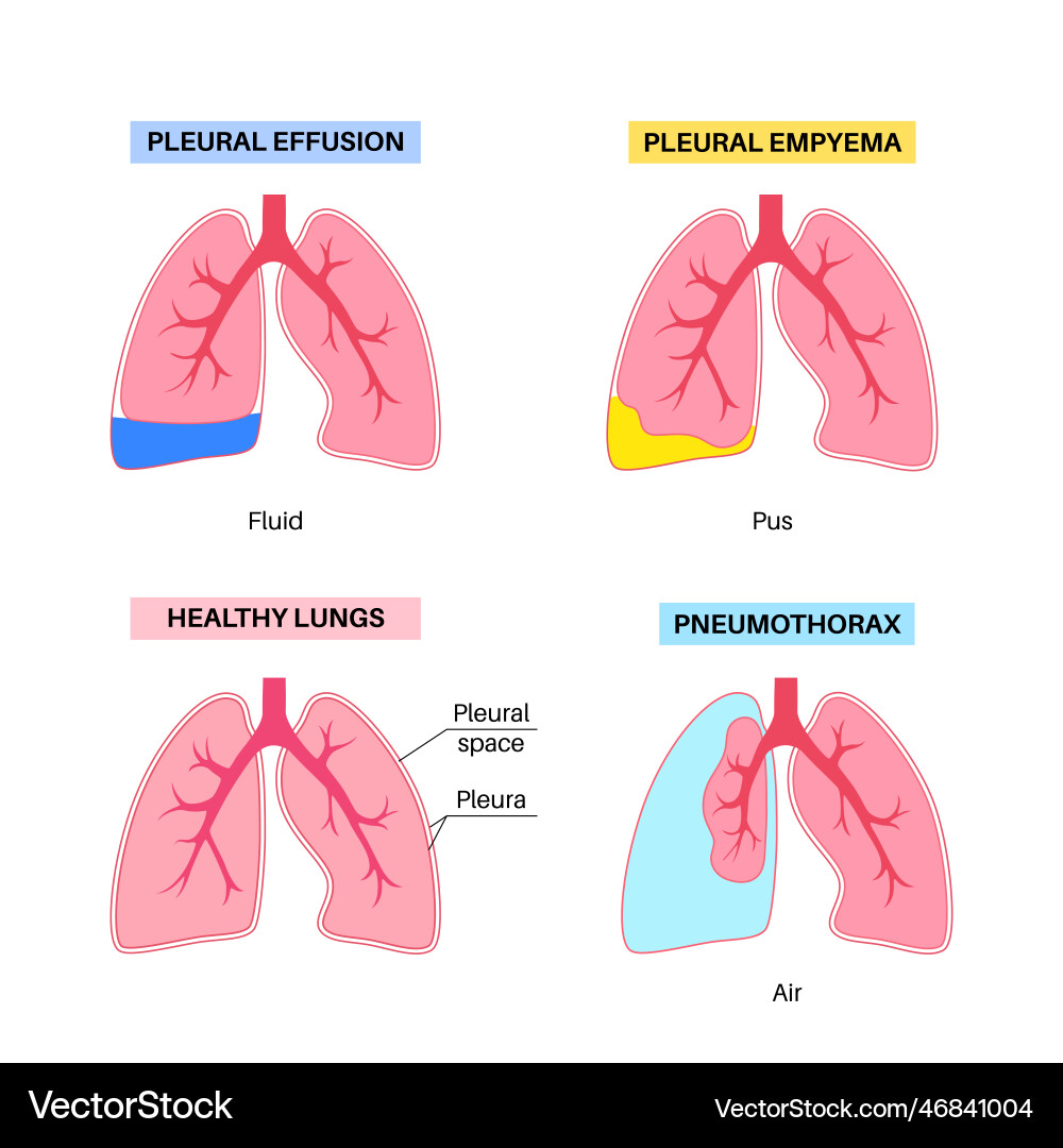 Pleural effusion poster Royalty Free Vector Image