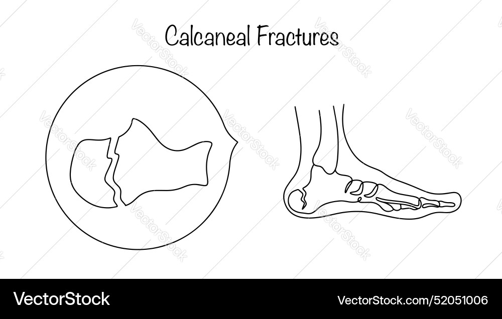 Calcaneal fractures Royalty Free Vector Image - VectorStock