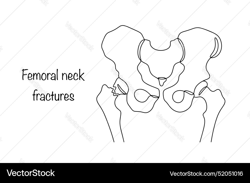 Femoral neck fractures Royalty Free Vector Image