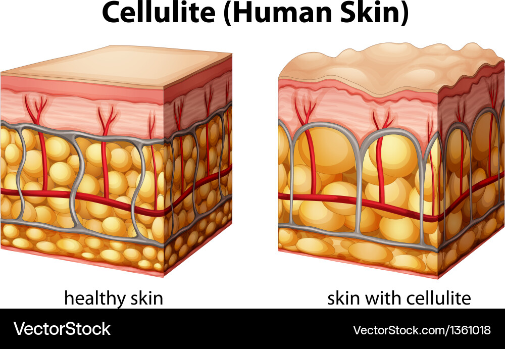 Cellulite Royalty Free Vector Image - VectorStock