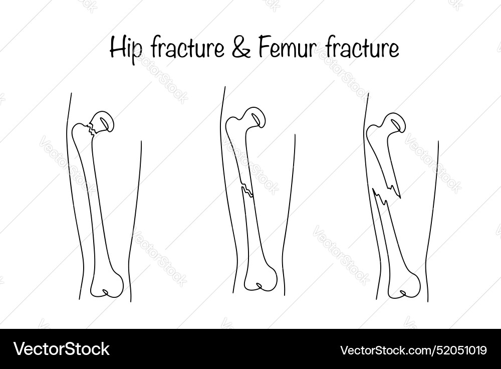 Hip fracture Royalty Free Vector Image - VectorStock
