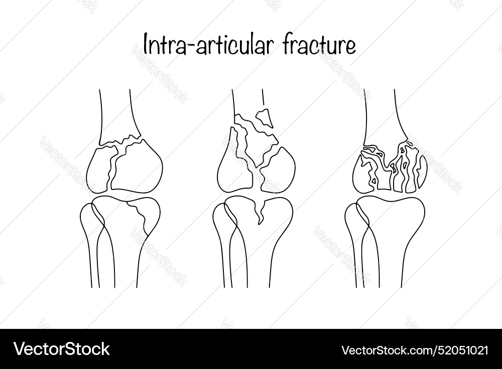 Intra-articular fracture Royalty Free Vector Image