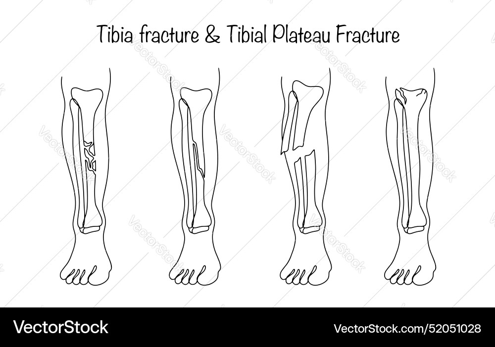 Tibia fracture Royalty Free Vector Image - VectorStock