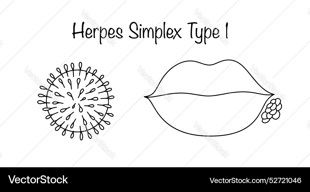 Herpes simplex type 1 Royalty Free Vector Image