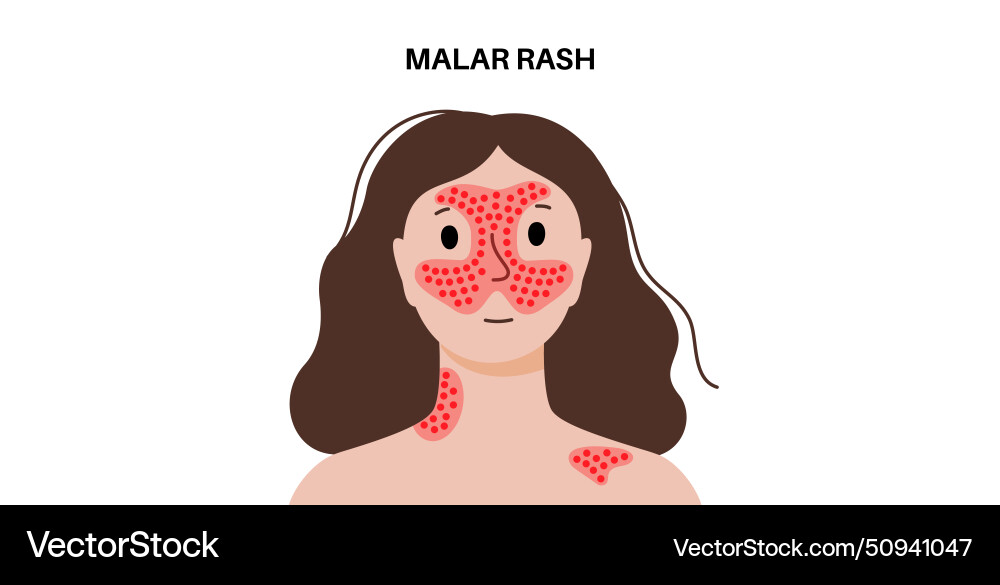 Systemic lupus erythematosus Royalty Free Vector Image