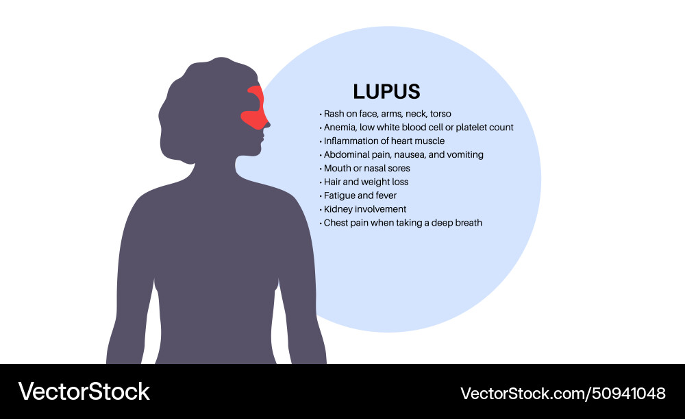 Systemic lupus erythematosus Royalty Free Vector Image
