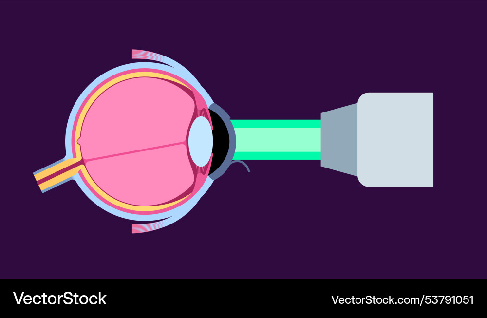 Lasik eye surgery Royalty Free Vector Image - VectorStock