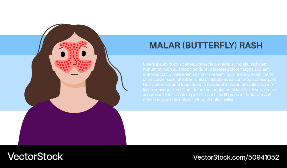 Systemic lupus erythematosus Royalty Free Vector Image