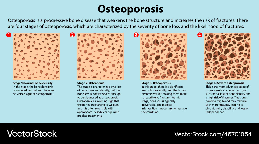 Bone density and osteoporosis Royalty Free Vector Image