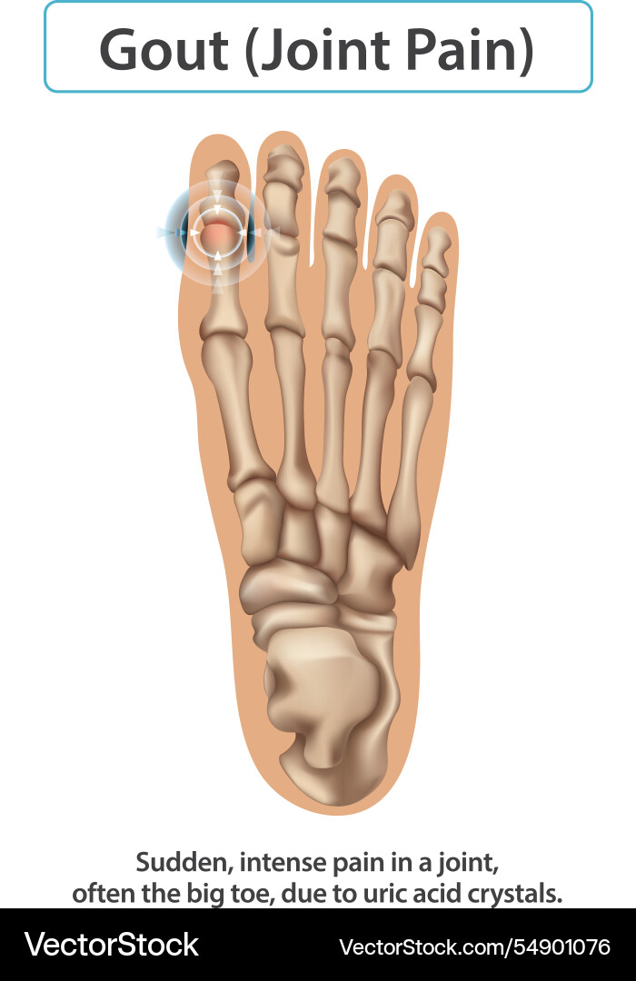 Gout affecting the foot joint Royalty Free Vector Image