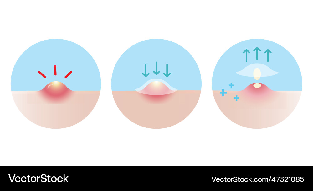 Acne pimple patch for pustule icon set Royalty Free Vector