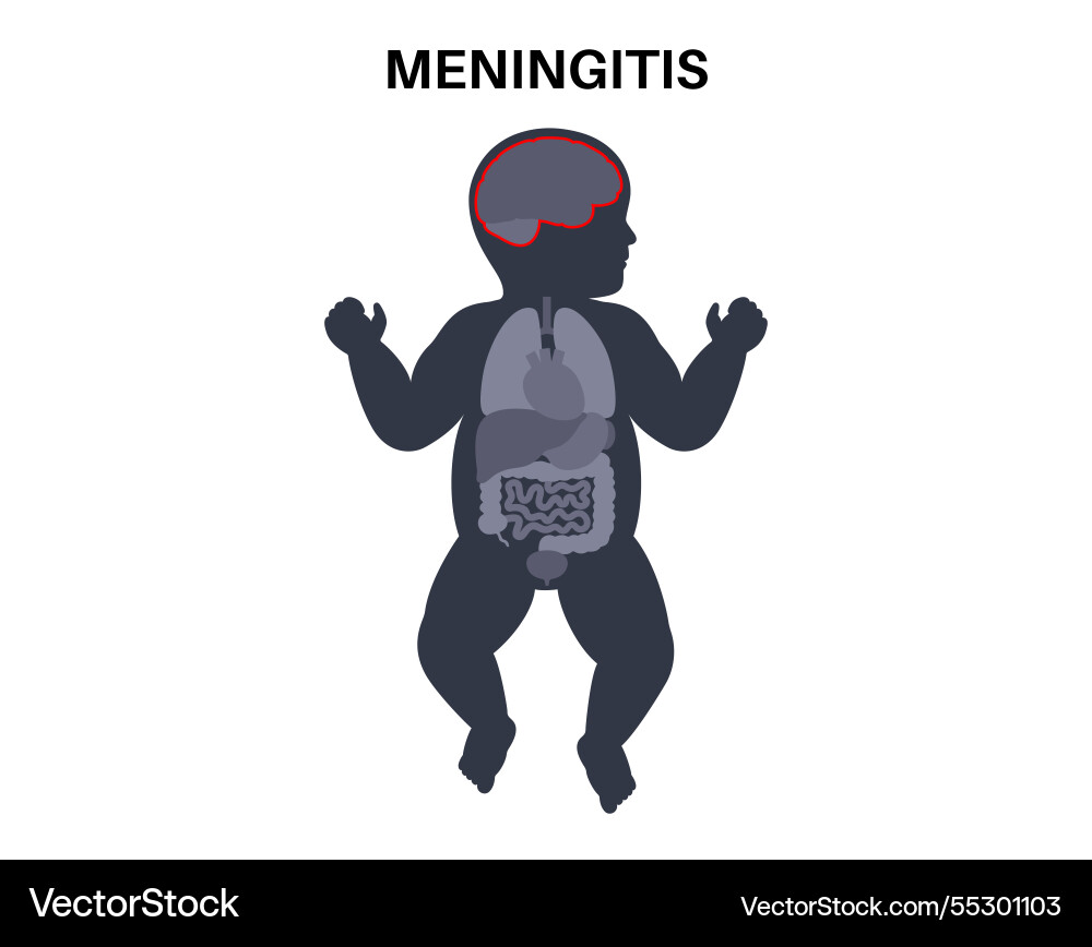 Meningitis medical poster Royalty Free Vector Image