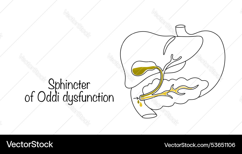 Sphincter of oddi dysfunction Royalty Free Vector Image