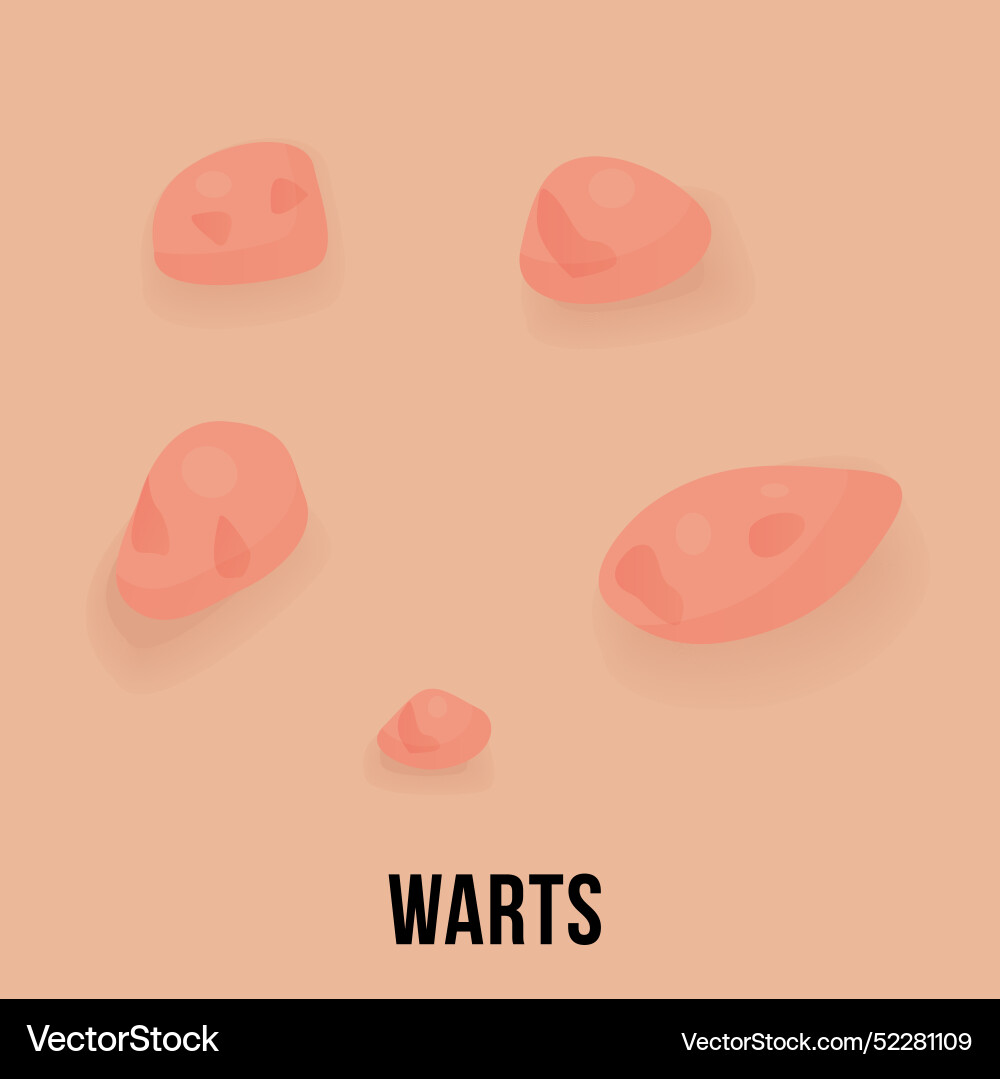 Multiple warts on skin Royalty Free Vector Image