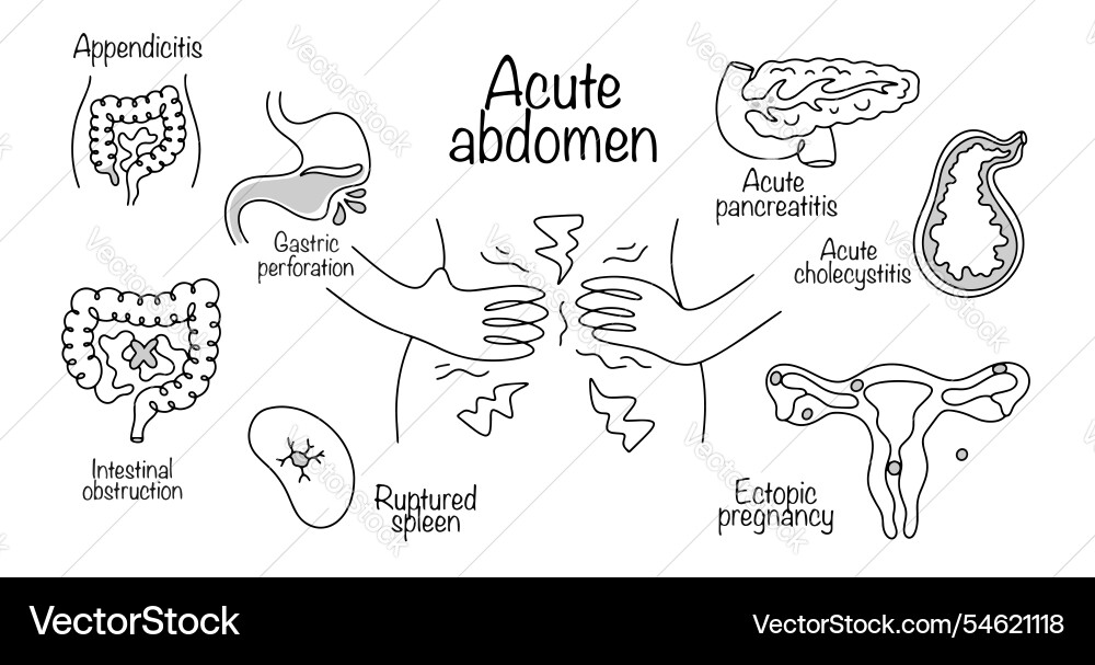 Acute Abdomen - Causes & Symptoms Royalty Free Vector