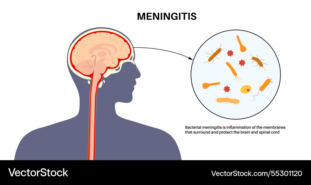 Meningitis medical poster Royalty Free Vector Image